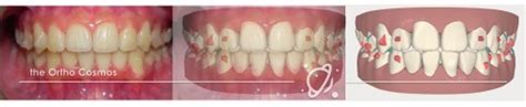Using Attachments In Clear Aligner Therapy The Ortho Cosmos
