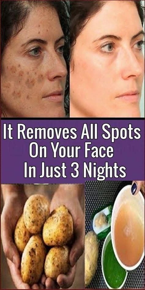 Brown Spots On Skin Artofit