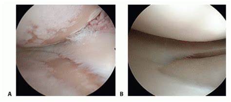 Upper Tibial Osteotomy High Tibial Osteotomy Musculoskeletal Key