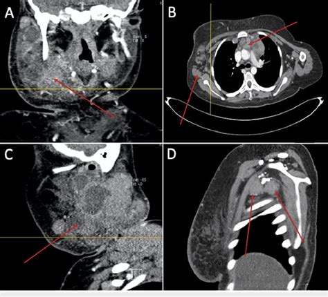 Ct Scan Of An 18 Year Old Female Showing Multiple Enlarged Lymph Nodes