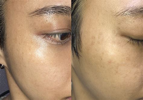 루비레이저 한달 후기 끔찍한 색소침착이 올라왔다 피코토닝으로 변경 효과 부작용 관리 루비 레이저 가격 루비 토닝 루비 피코 레이저