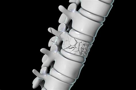 Spine Compression Fracture Treatment In Singapore Spire Ortho Spine Compression Fracture Treatment In Singapore Spire Ortho