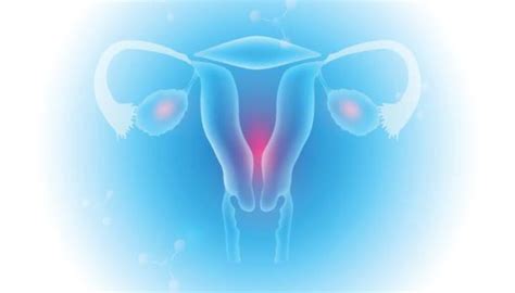 Uterine Sarcoma Understanding A Rare But Important Cancer
