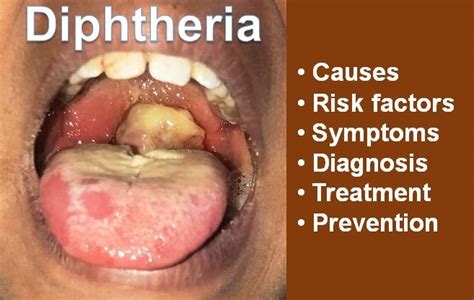 Diphtheria Explained For Africans