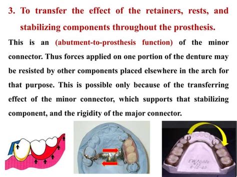 Minor Connectors Preclinical Removable Partial Denture Ppt Dental