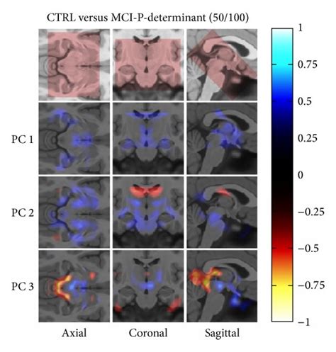 Significant Structural Differences Within The Medial Temporal Lobe Download Scientific Diagram