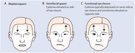 Cranial Functional Psychogenic Movement Disorders The Lancet Neurology