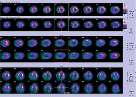 Lexiscan Stress Myocardial Perfusion Imaging Mpi Is Clinically And