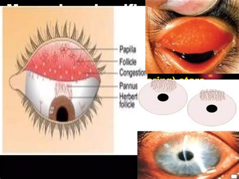 Conjunctival Diseases By Dr Abdul Basir Safi Ppt Ear Nose And Throat Conditions Diseases