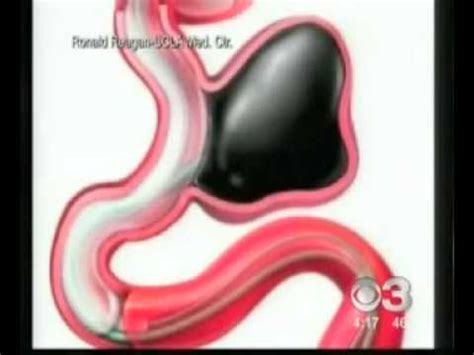 Fixing Aneurysm With Glue YouTube