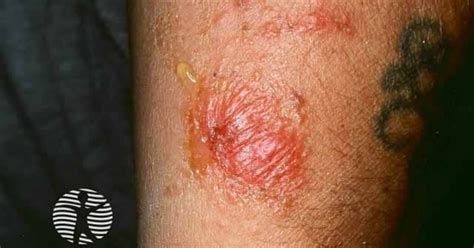 Plant Dermatitis Image