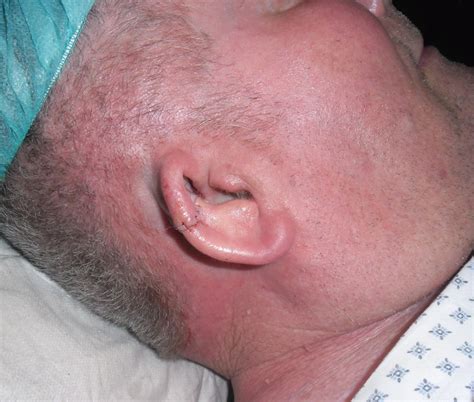 Squamous Cell Carcinoma Of The Ear Conch Doccheck