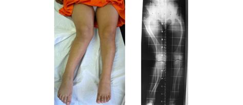 Deformidades Angulares Adolescere Sema