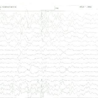 EEG Showing Multifocal Simultaneous Left Temporal Right Temporal And Download Scientific