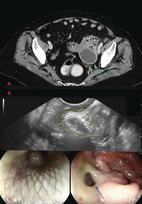 Diverticular Abscess With Eus Guided Drainage And Lams Placement A A Download Scientific