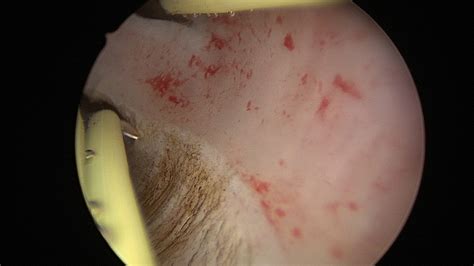 Transcervical Resection Of The Endometrium Gynaecologia