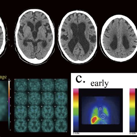 A Brain Computed Tomography Showed Disproportionately Enlarged Download Scientific Diagram