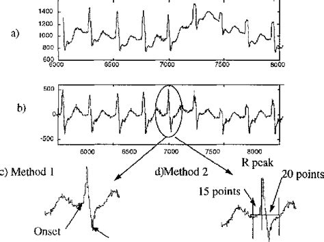 Figure 3 From Previous Identification Of Qrs Onset And Offset Is Not