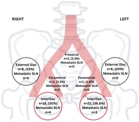 Sentinel Lymph Node Detection In Cervical Cancer Challenges In Resource Limited Settings With