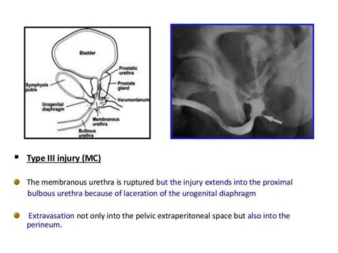 Retrograde Urethrogram For Urology Residents Pptx