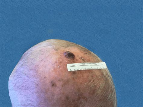 Mohs Scalp Patient 01 Pasadena And Newport Beach Dr Hung