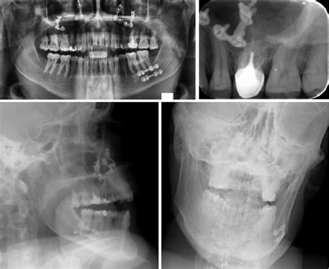 Antemortem Top And Postmortem Bottom With Orthognathic Surgery Download Scientific Diagram
