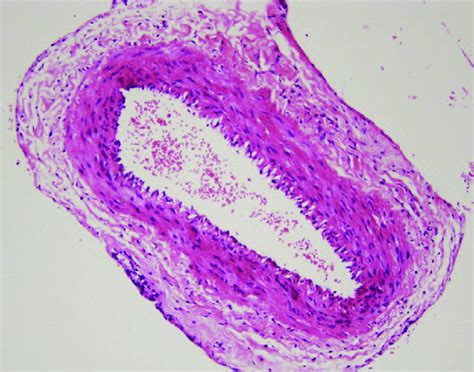 Endothelialization Is Seen Without Any Inflammation And Foreign Body