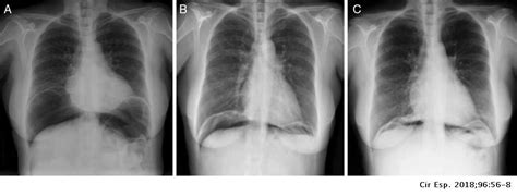 Conservative Management Of Massive Pneumoperitoneum After Argon Plasma Coagulation Cirugía
