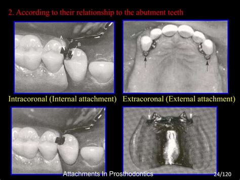 Attachments In Prosthodontics Pptx