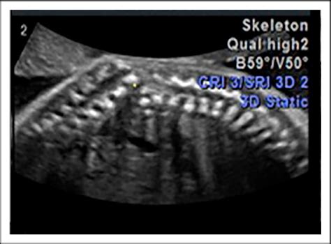 Atypical Segmental Spinal Dysgenesis Prenatal Diagnosis With Postpartum Short Term Follow Up