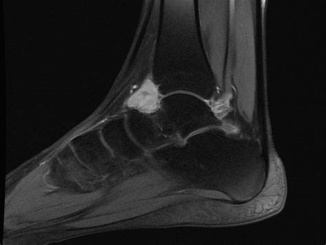 Pigmented Villonodular Synovitis