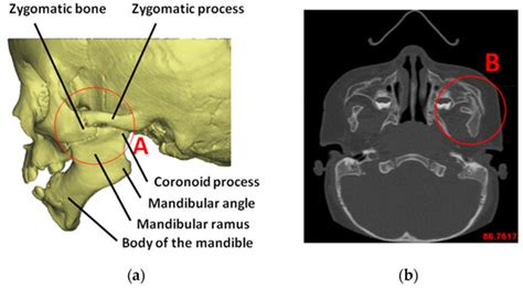 Condyloid Process And Mandibular Condyle