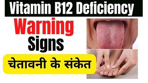 Vitamin B12 Ki Deficiency Se Kya Hota Hai Vitamin B12 Deficiency