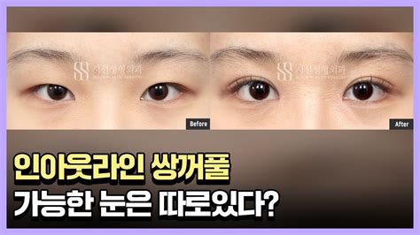 인아웃라인쌍꺼풀 가능한 눈은 따로있다 자연유착쌍꺼풀 앞윗트임 Youtube