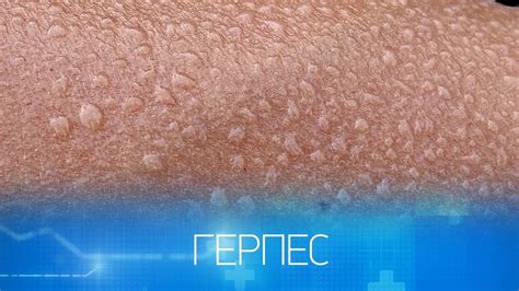 Герпес: причины, признаки, симптомы, лечение Herpes