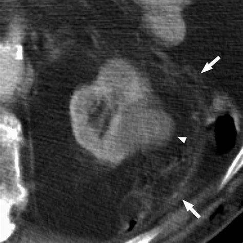 Ct And Mr Imaging After Imaging Guided Thermal Ablation Of Renal Neoplasms Radiographics