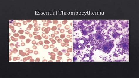 Myeloproliferative Disorders Mpd Pptx