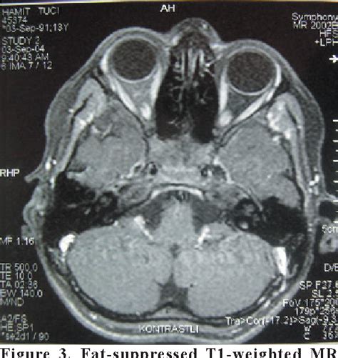 Figure 3 From Minimal Invasive Excision Of Intraorbital Dermoid Cyst Semantic Scholar