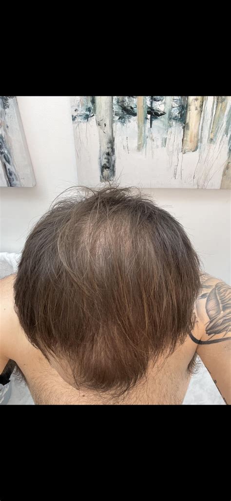 1mg Daily Of Fin And Inconsistent Minoxidil Usage I Am Using Min More Consistently Now But The