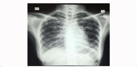 Cxr Show Extensive Reticulonodular Shadowing With Honey Combing And Cxr Show Extensive Reticulonodular Shadowing With Honey Combing And