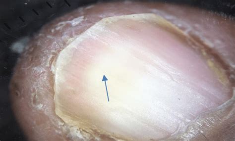 Multiple Dilated Capillaries Seen In Onychodermal Band Arrow Download Scientific Diagram