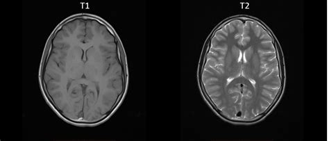 T1 Vs T2 Brain Mri Structural Mri Imaging Hilsd