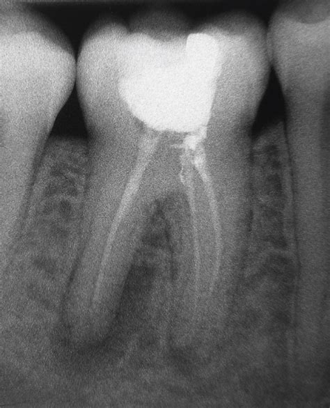 Removal Of Root Canal Filling Materials Pocket Dentistry