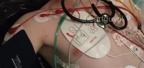 External Heart Pacing