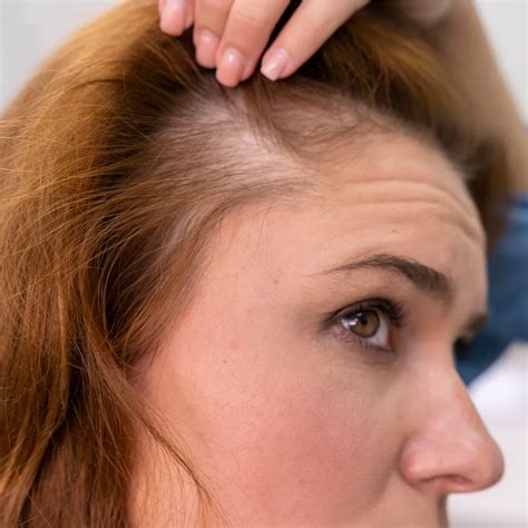 What Causes Female Androgenetic Alopecia Lyskin