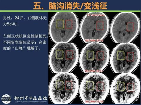 【影像】头颅ct如何预判超早期脑梗死？ 脑医汇