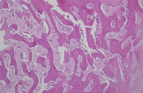 Histopathologic Examination Mature Lamellar Bone Is Located At The