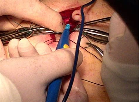 Placement Of Autosuture™ Port During Robotic Radical Prostatectomy With