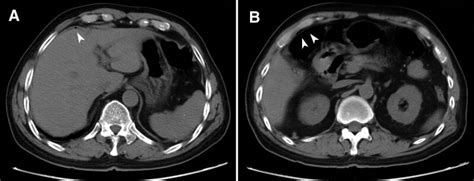 Small Bowel Perforation Caused By Thermal Injury During Colonic