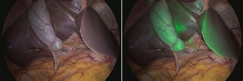 Indocyanine Green Icg Fluorescent Cholangiography During Laparoscopic